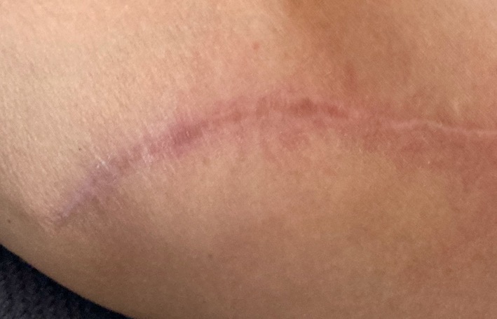 Scar Tissue Release – Golden Wattle Wellness